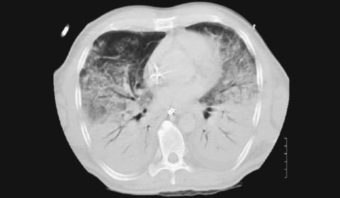 Akutes Lungenversagen - Schwerpunkt ARDS Syndrom - Diagnose und ...